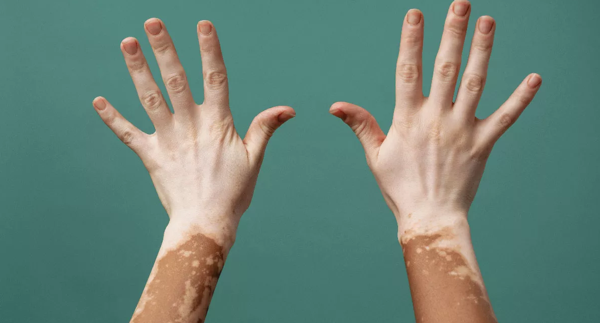 Understanding Vitiligo: Types, Treatments and Myths – Rising Kashmir